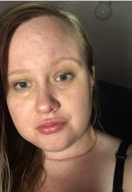 Scars fade on their own time – Young Adult Cancer Canada
